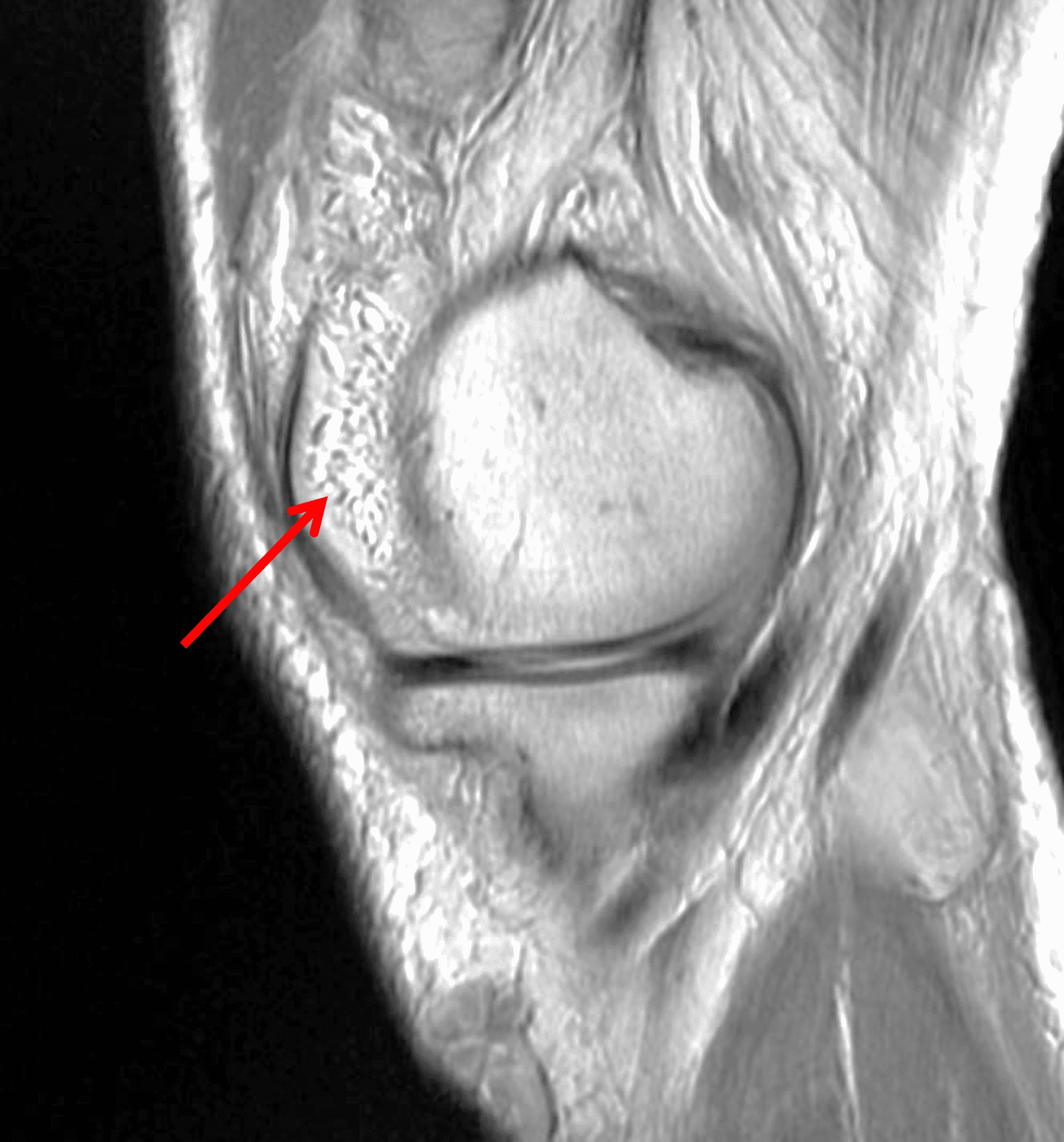 Intra-articular and Peri-articular Masses | Radsource
