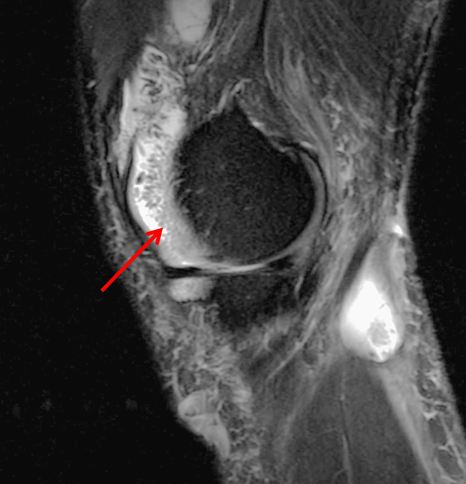 Intra-articular and Peri-articular Masses | Radsource