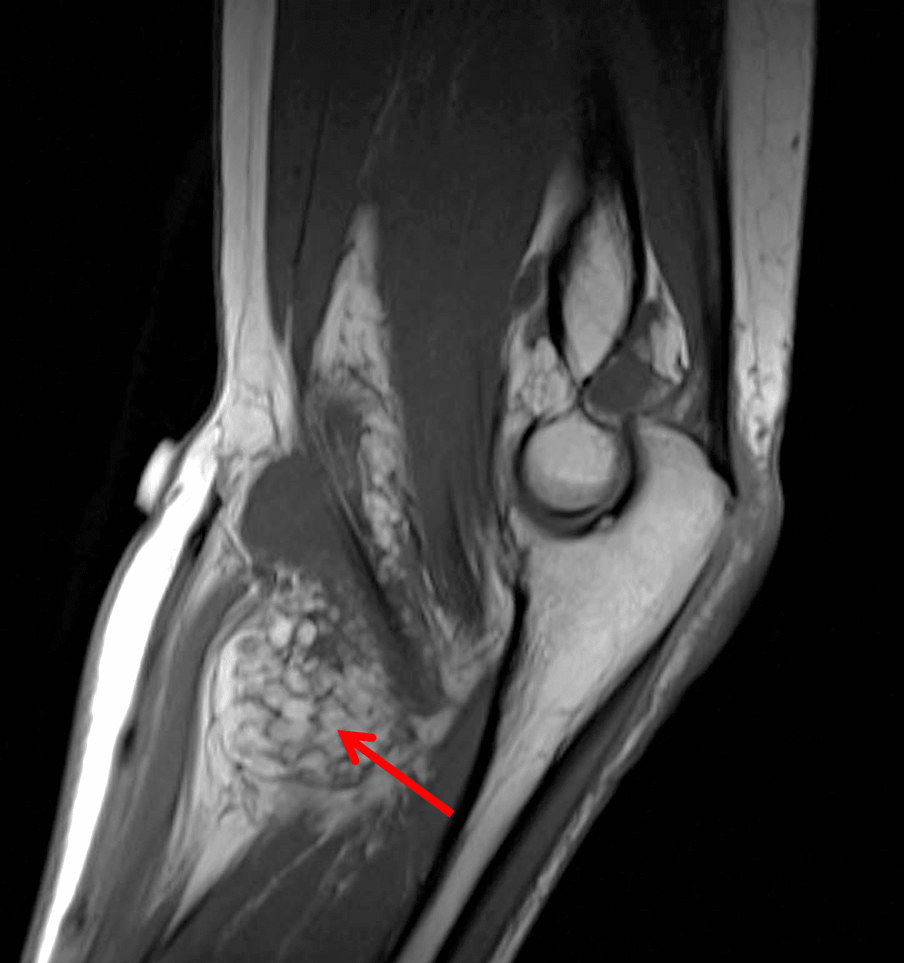 Intra-articular and Peri-articular Masses | Radsource