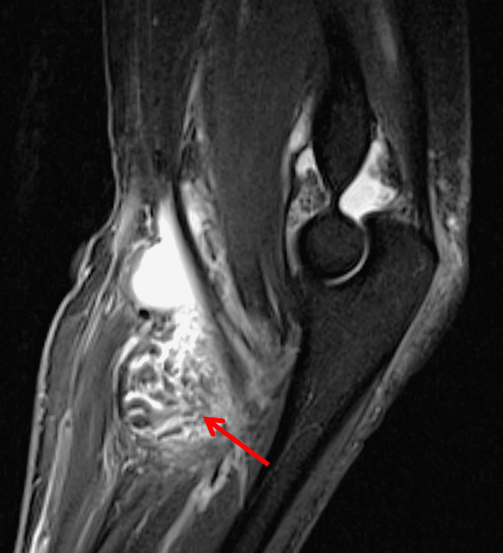 Intra-articular and Peri-articular Masses | Radsource