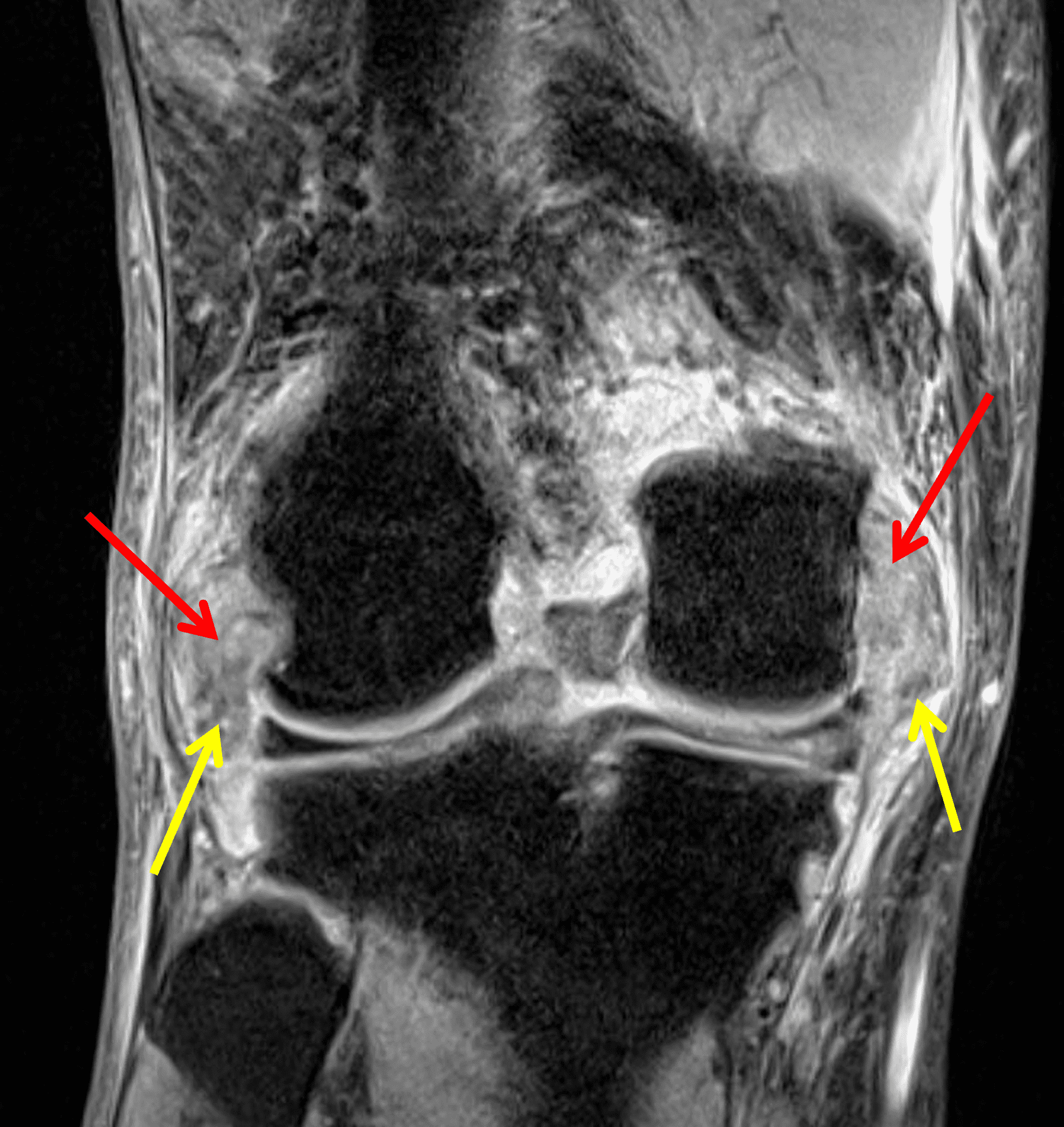 Intra-articular and Peri-articular Masses | Radsource
