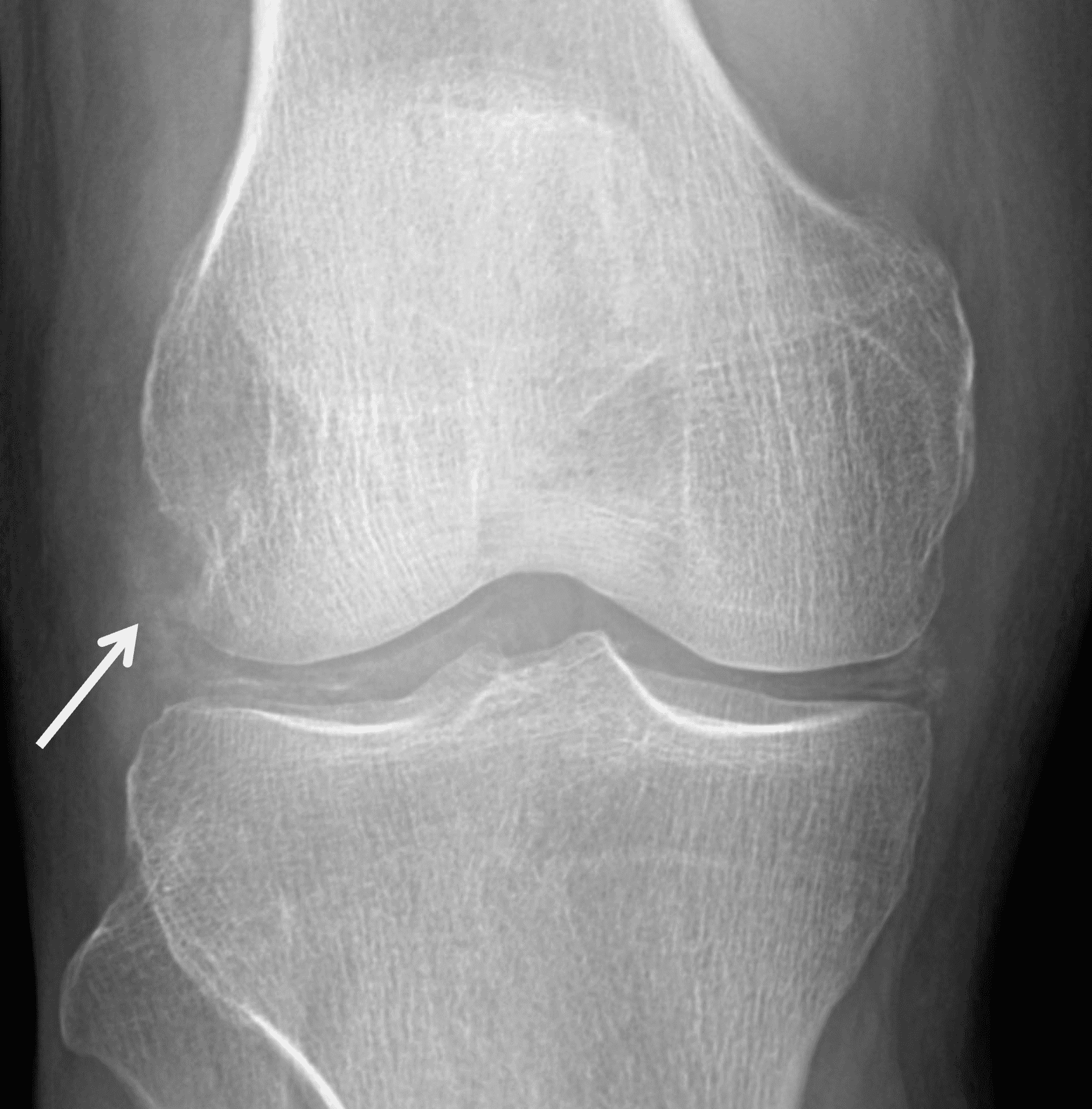 Intra-articular and Peri-articular Masses | Radsource