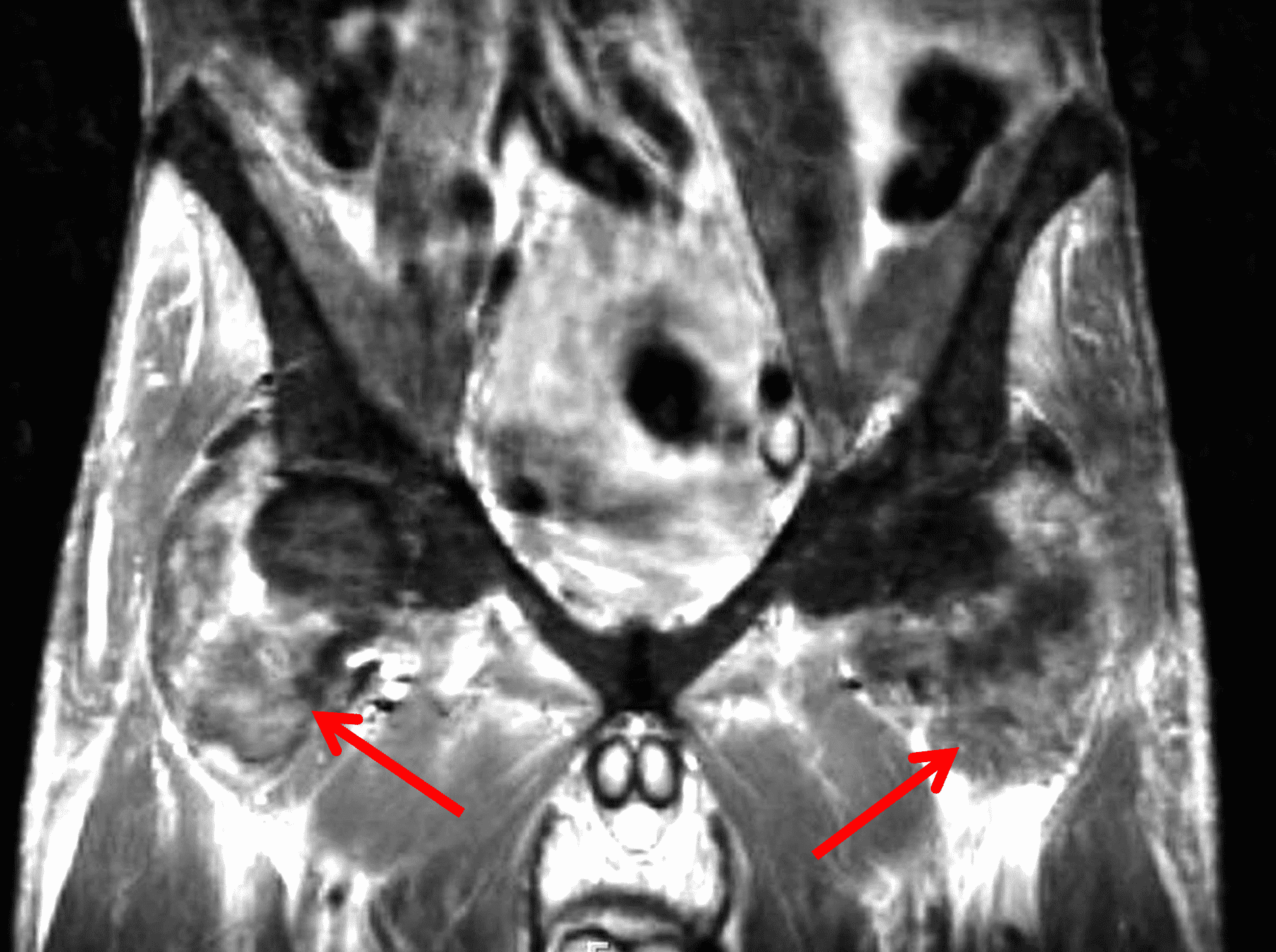 Intra-articular and Peri-articular Masses | Radsource