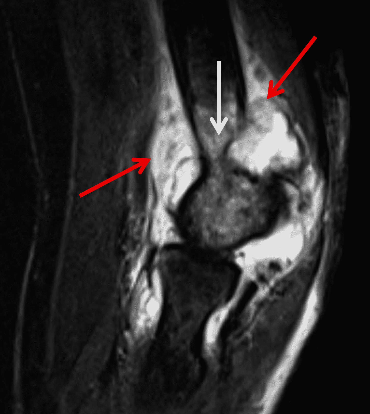 Intra-articular and Peri-articular Masses | Radsource
