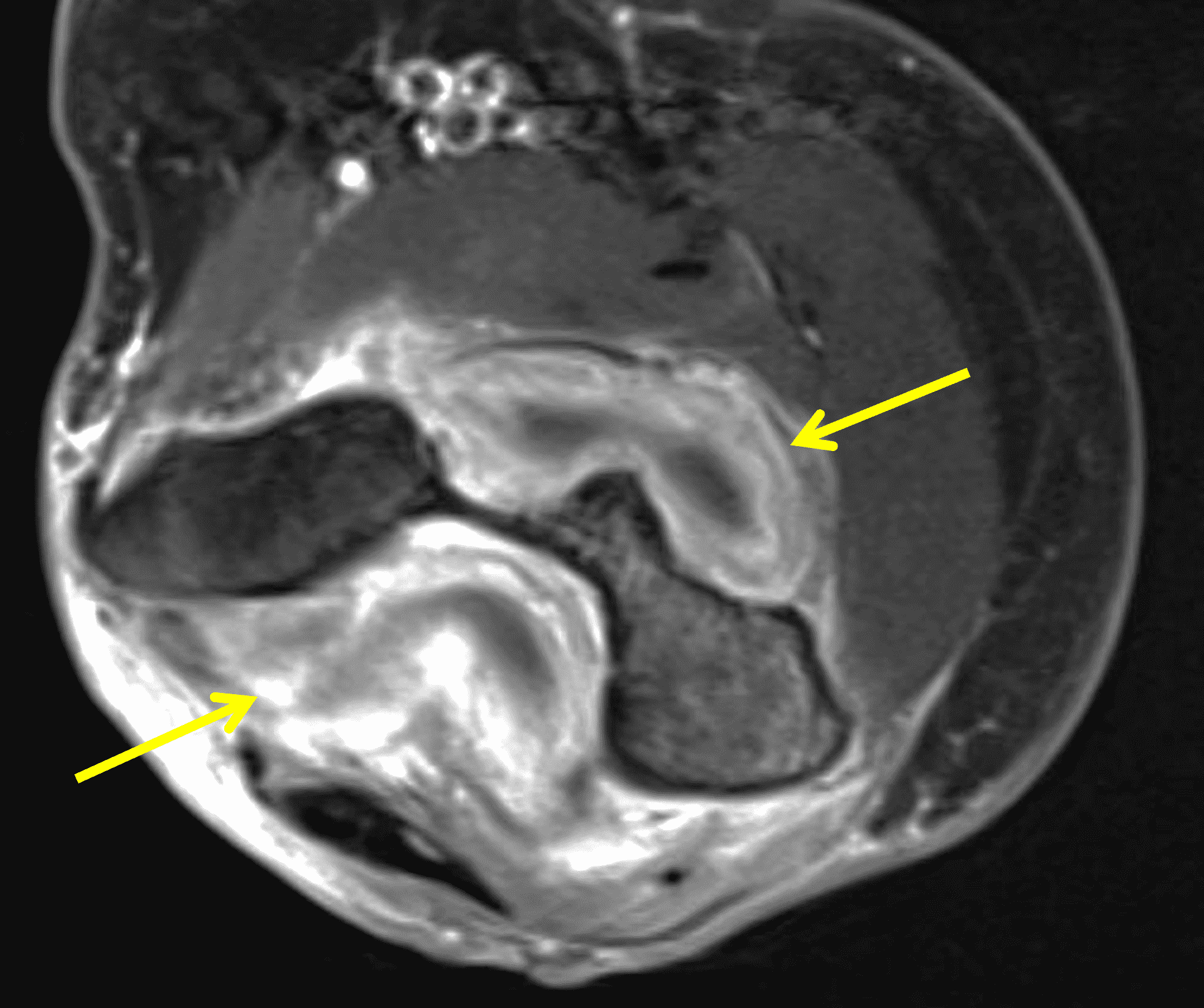 Intra-articular and Peri-articular Masses | Radsource