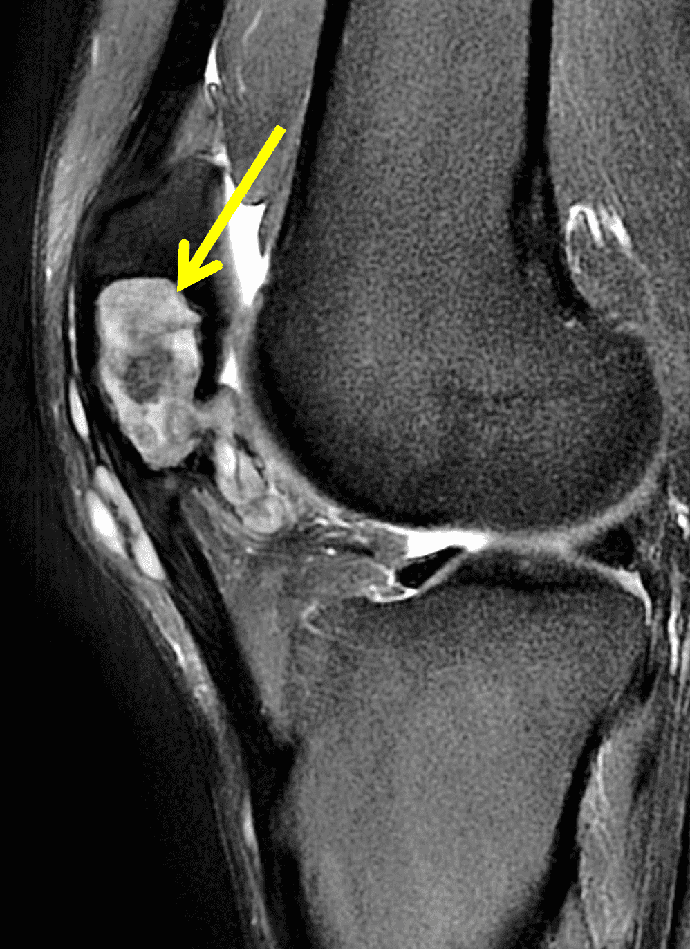 Intra-articular and Peri-articular Masses | Radsource