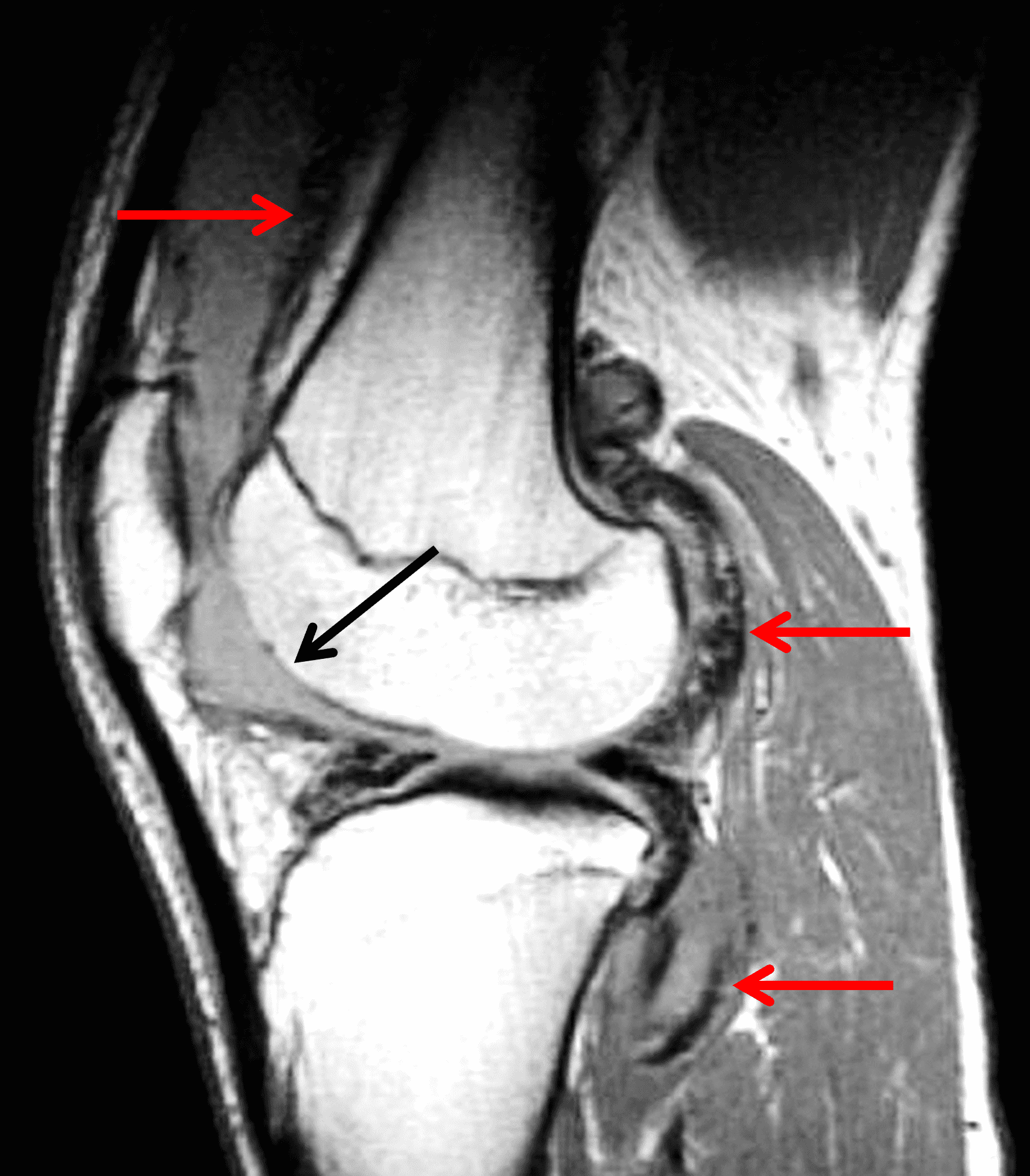 Intra-articular and Peri-articular Masses | Radsource