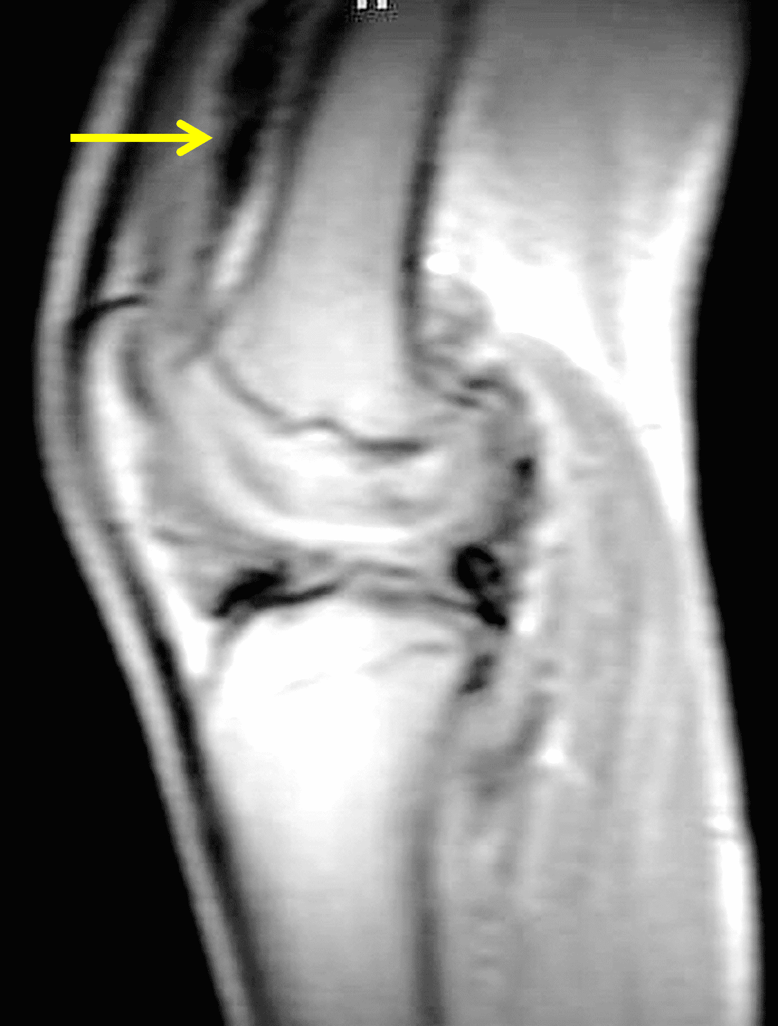 Intra-articular and Peri-articular Masses | Radsource