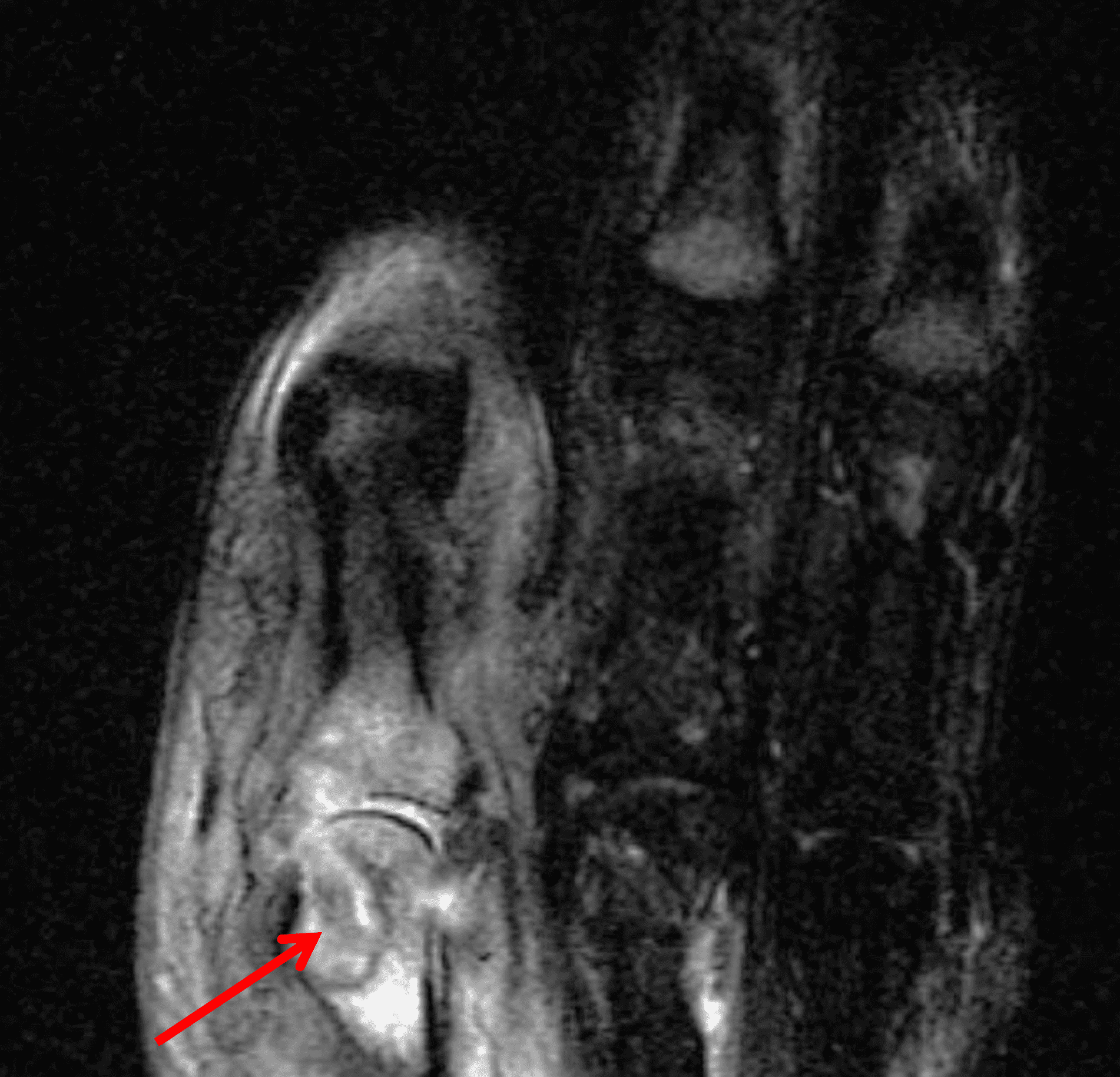 Intra-articular and Peri-articular Masses | Radsource