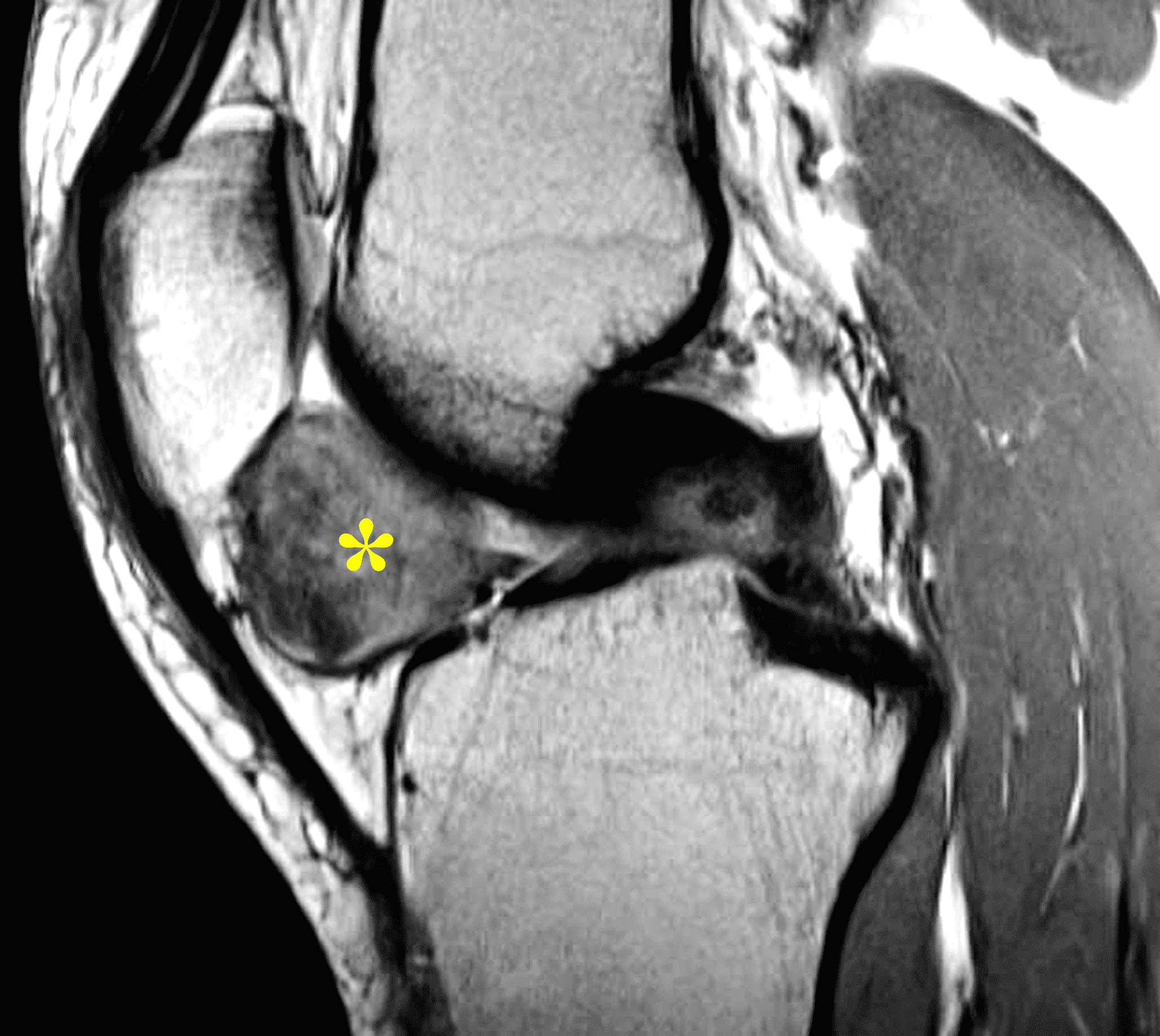 Intra-articular and Peri-articular Masses | Radsource