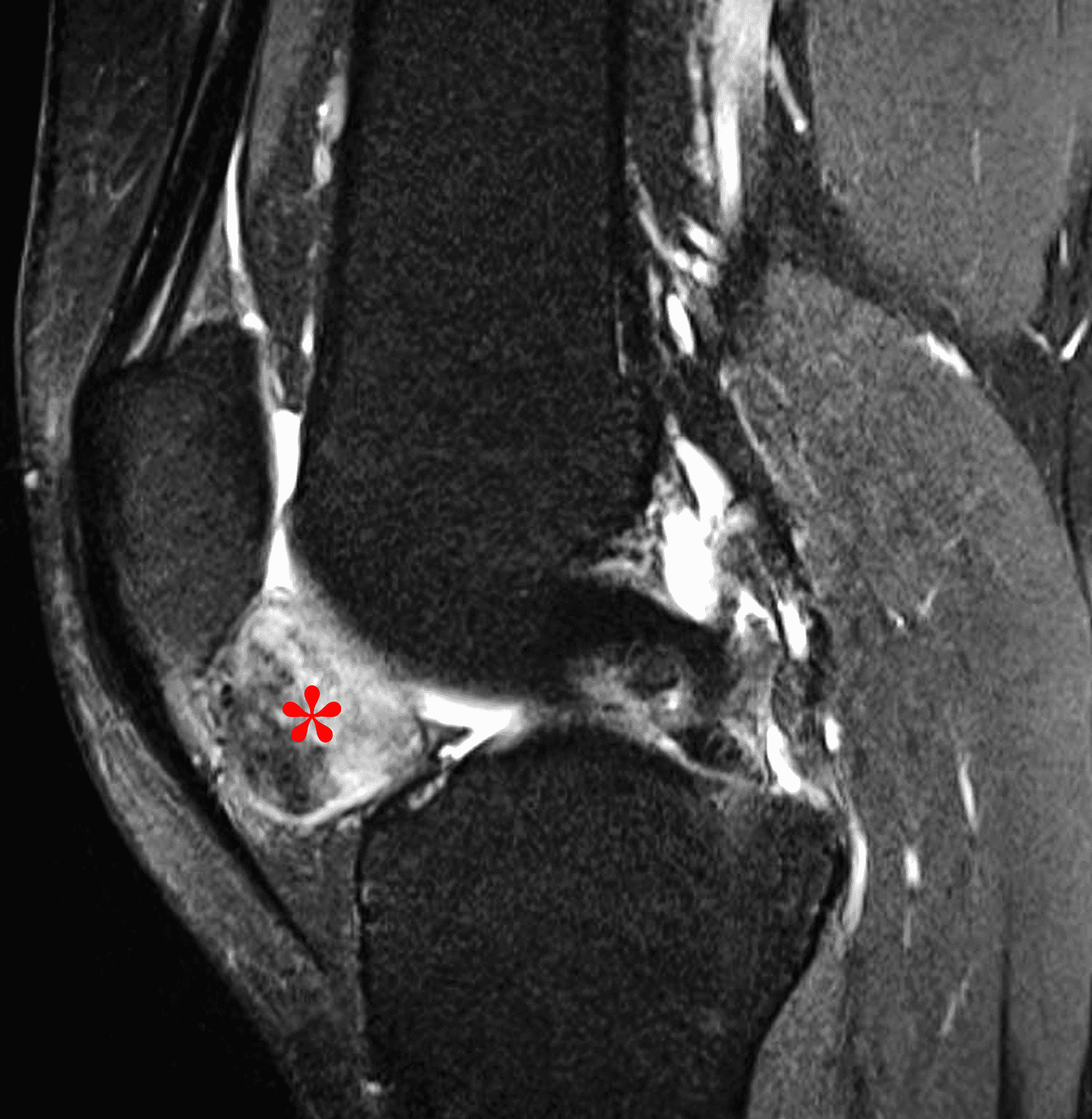 Intra-articular and Peri-articular Masses | Radsource