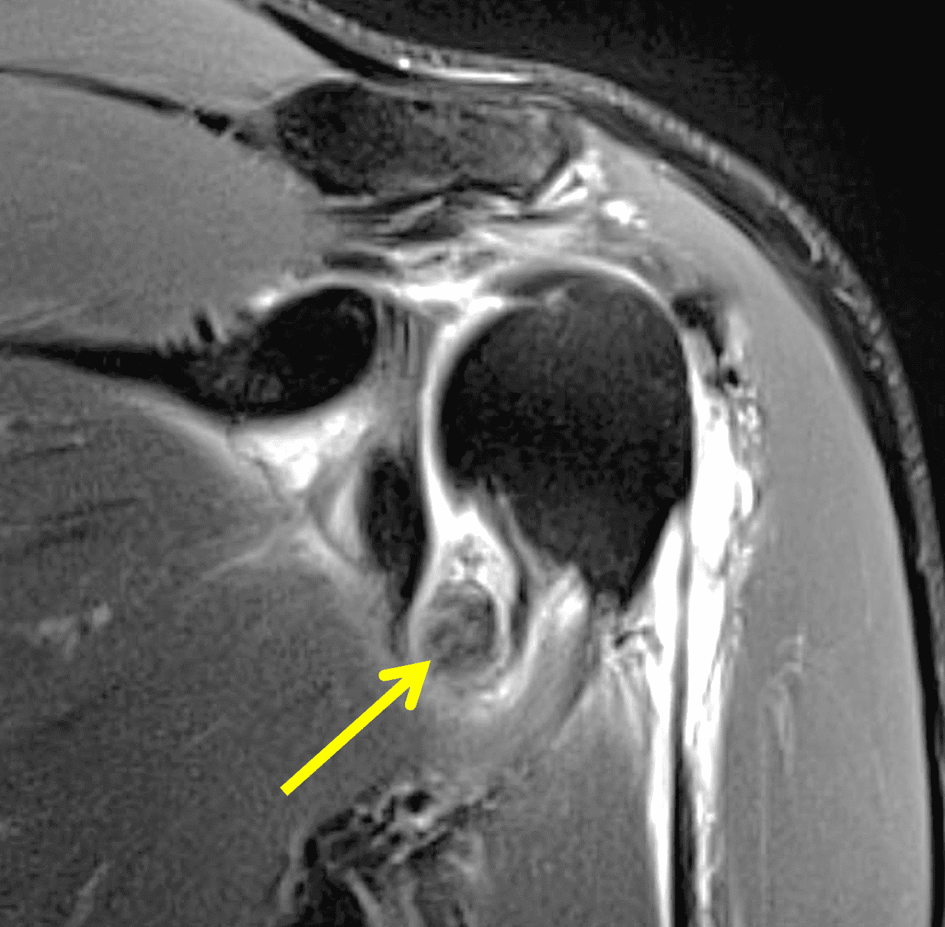 Intra-articular and Peri-articular Masses | Radsource