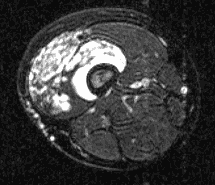 Intra-articular and Peri-articular Masses | Radsource
