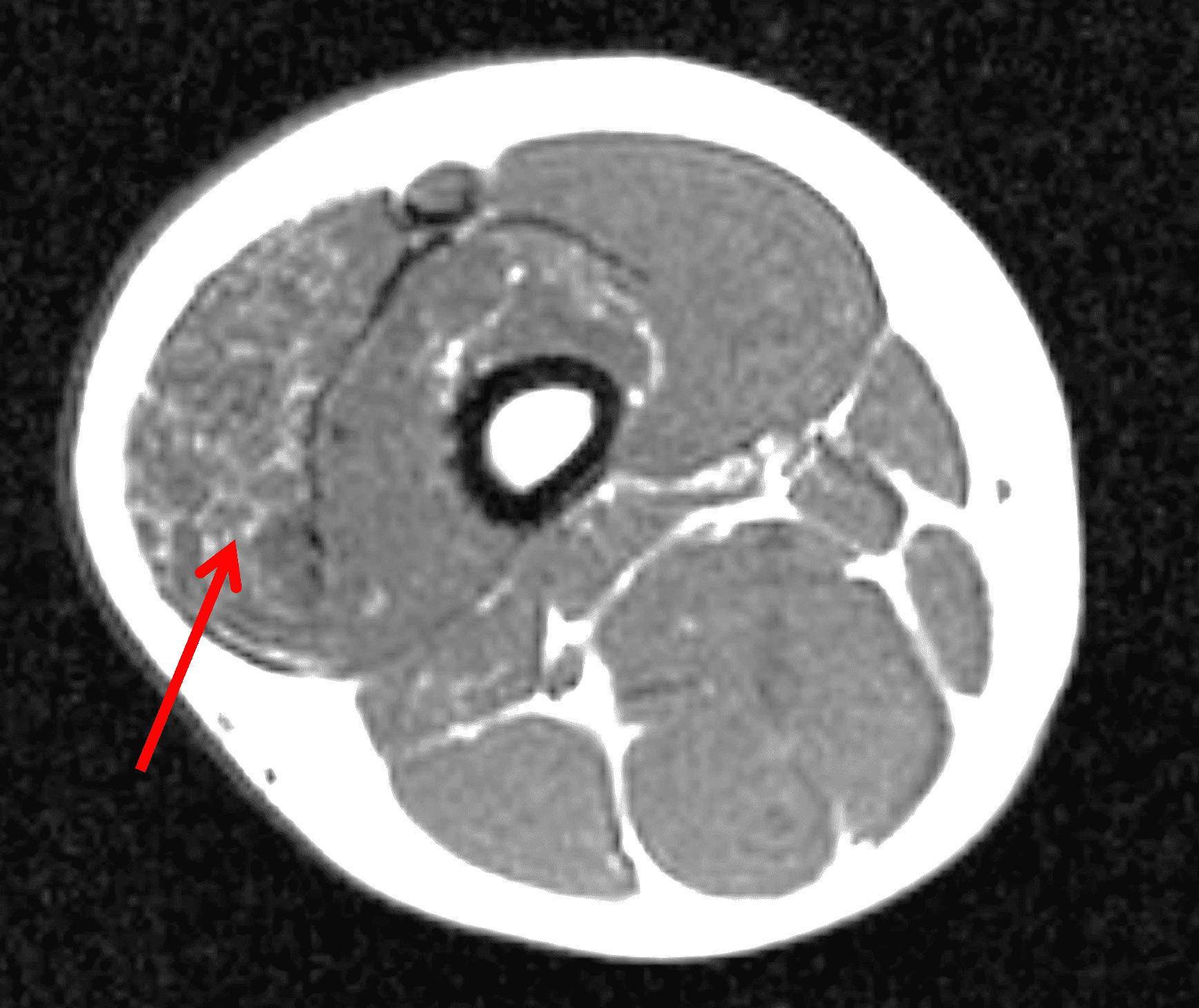 Intra-articular and Peri-articular Masses | Radsource