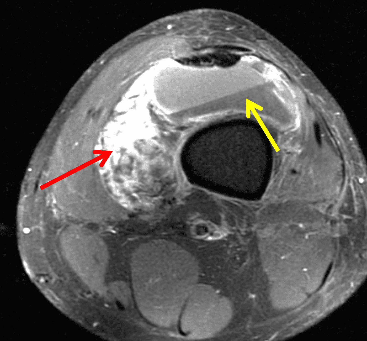 Intra-articular and Peri-articular Masses | Radsource