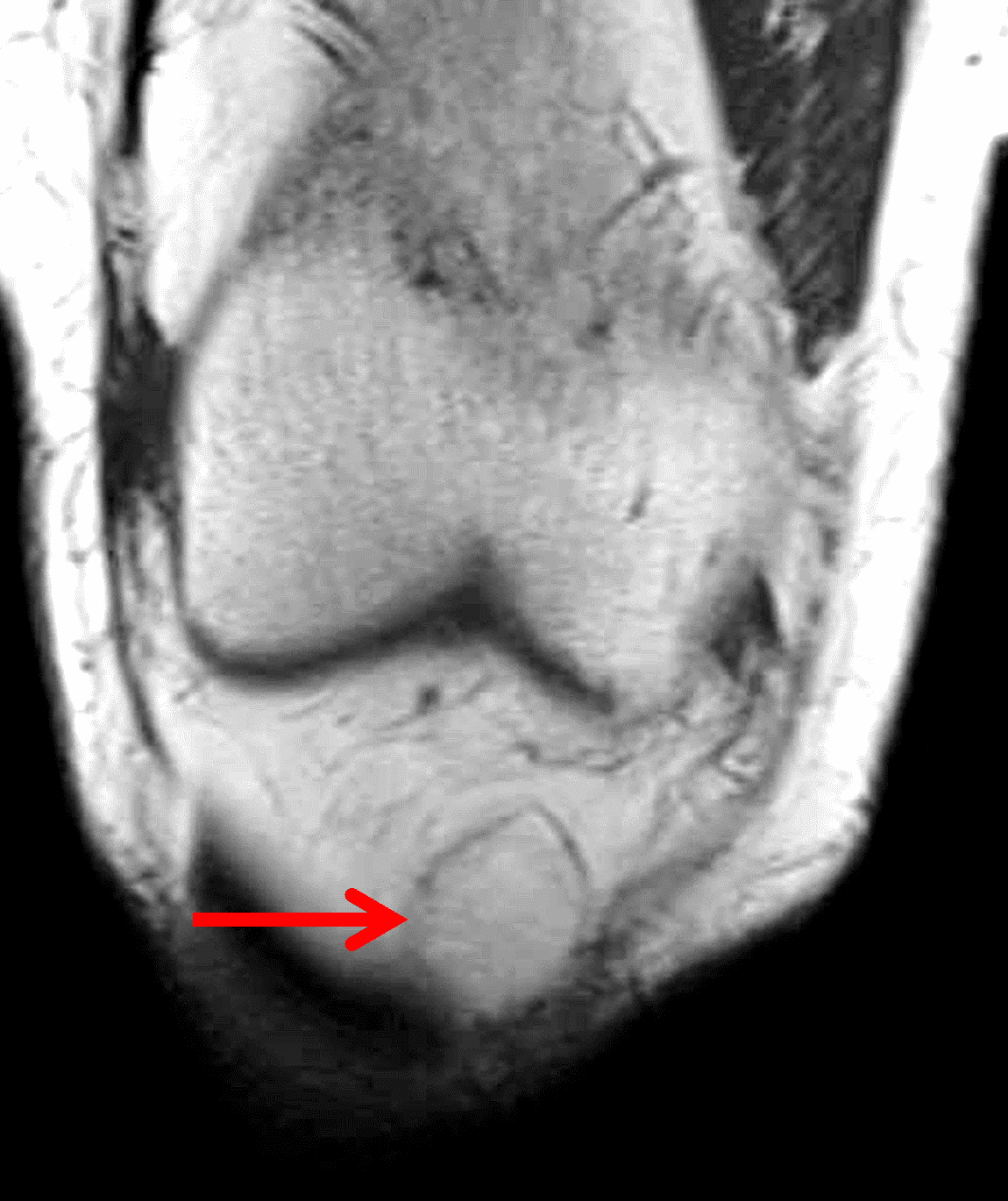 Intra-articular and Peri-articular Masses | Radsource
