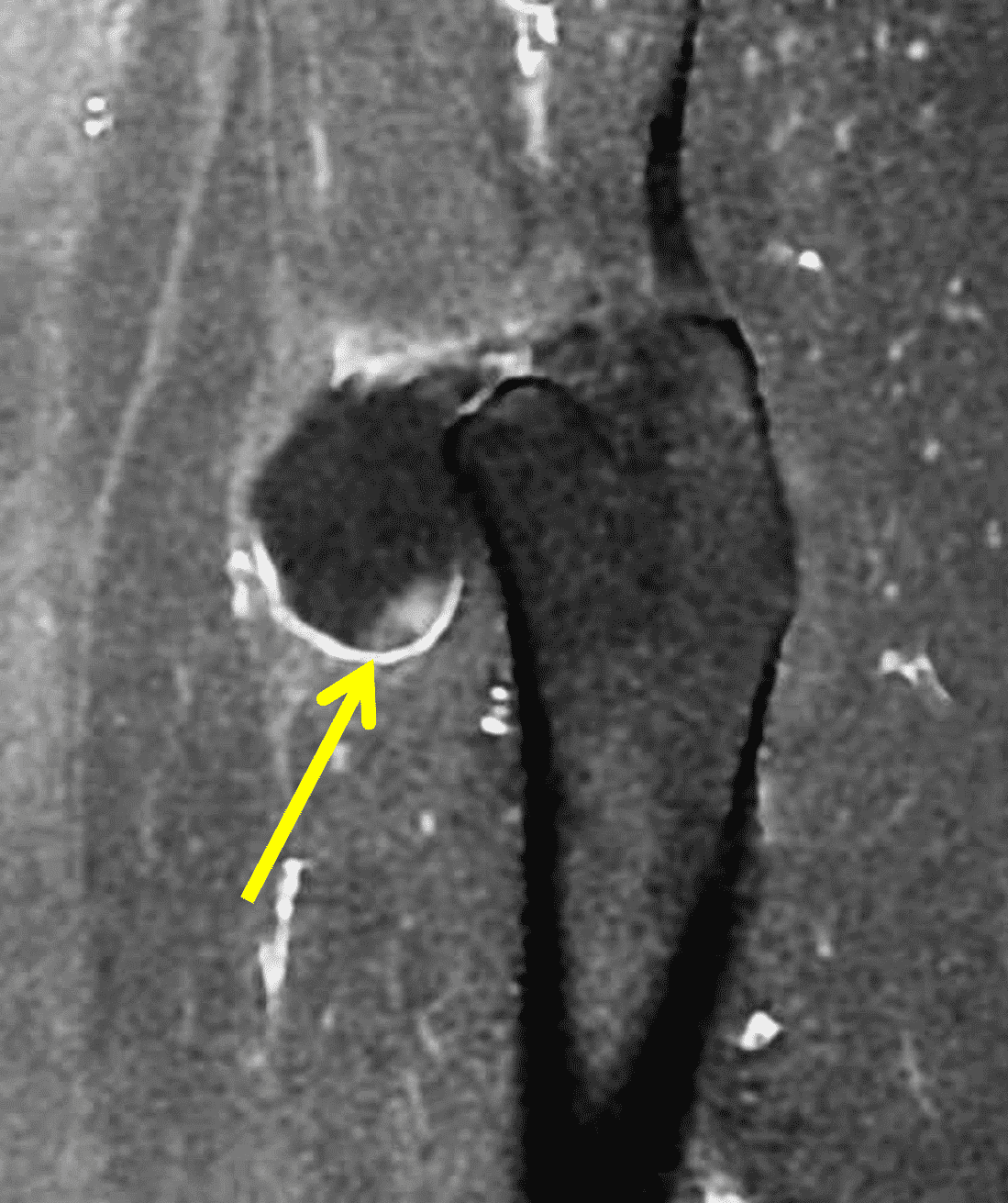 Intra-articular and Peri-articular Masses | Radsource