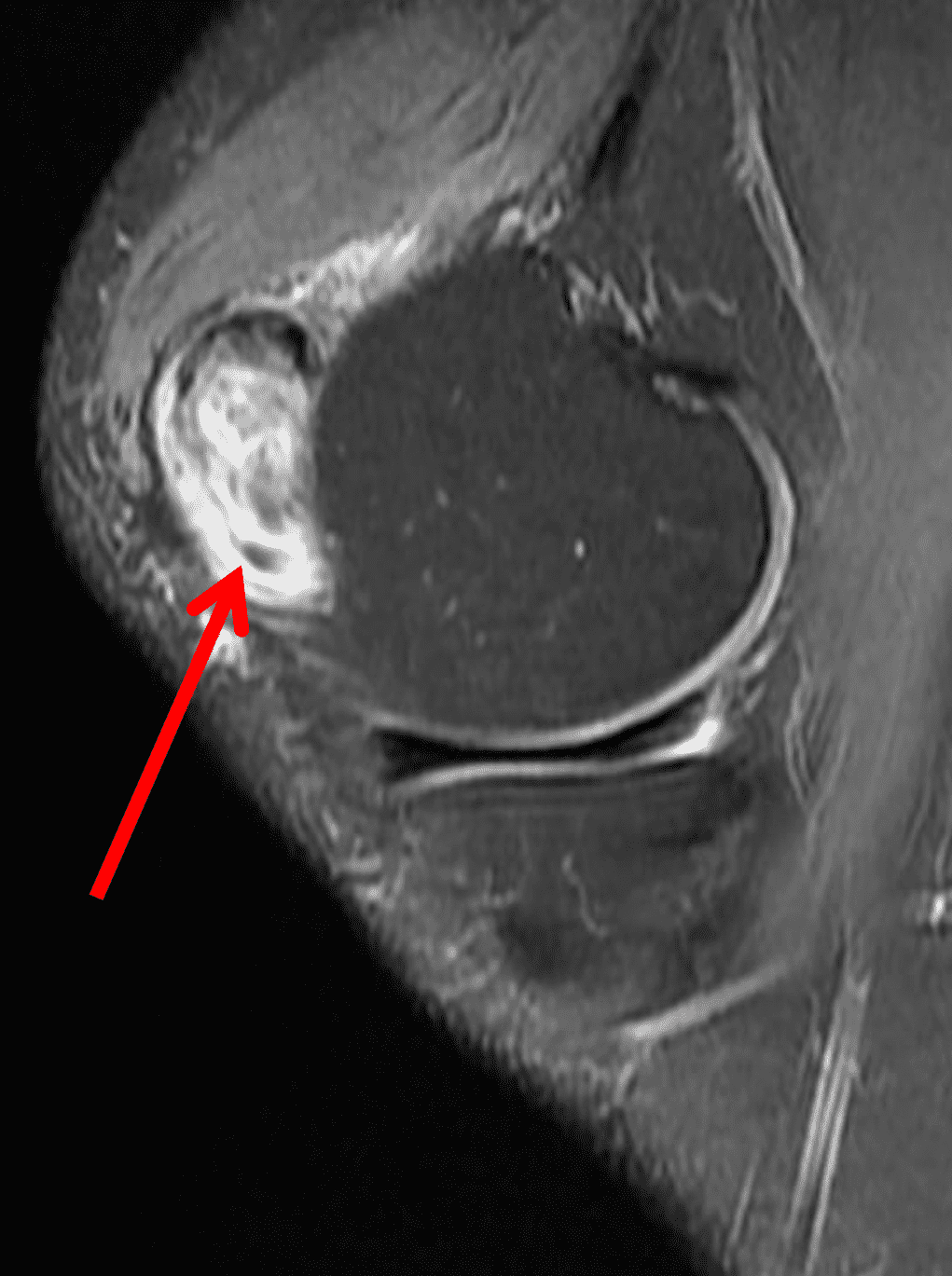 Intra-articular and Peri-articular Masses | Radsource