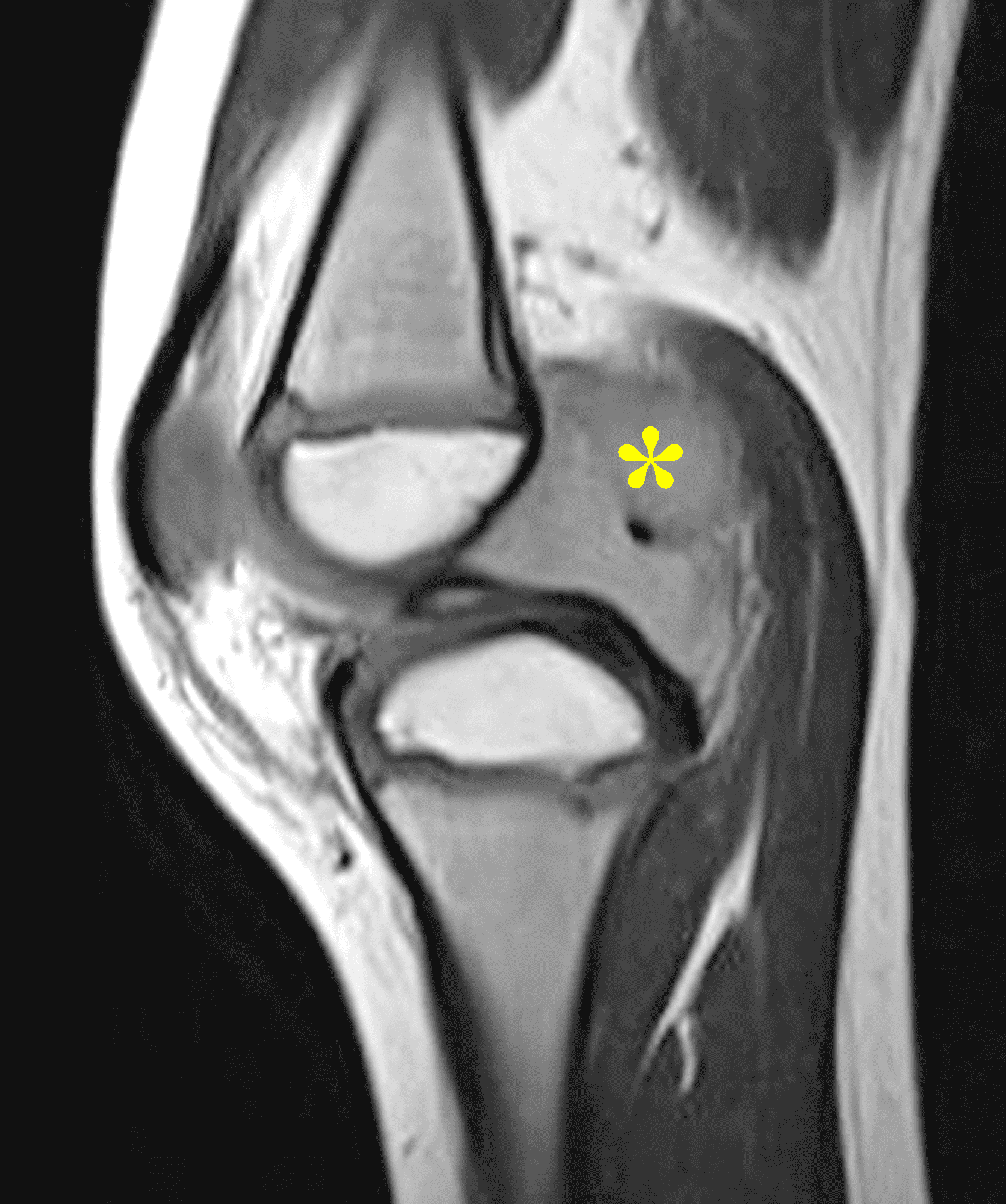 Intra-articular and Peri-articular Masses | Radsource