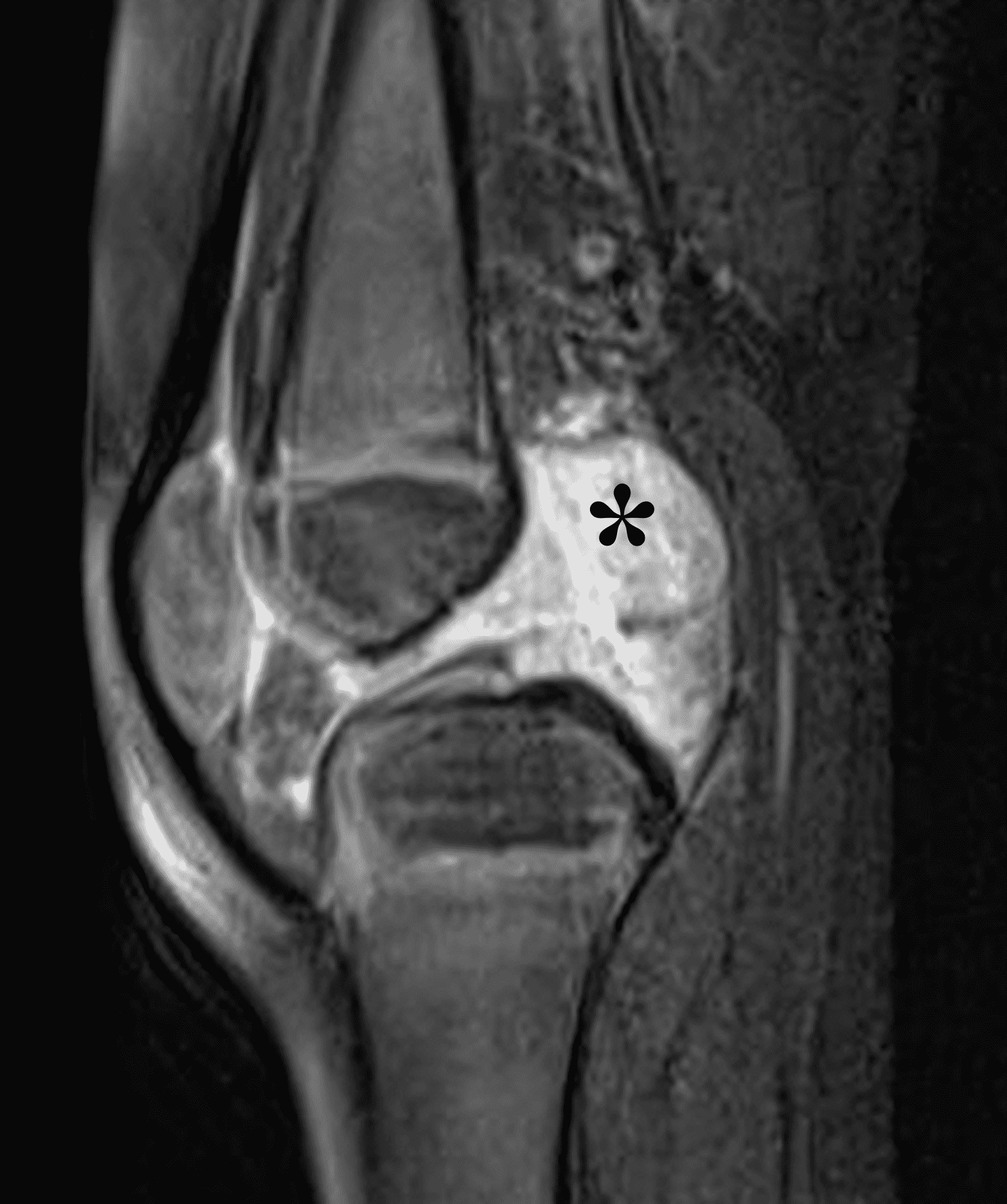 Intra-articular and Peri-articular Masses | Radsource