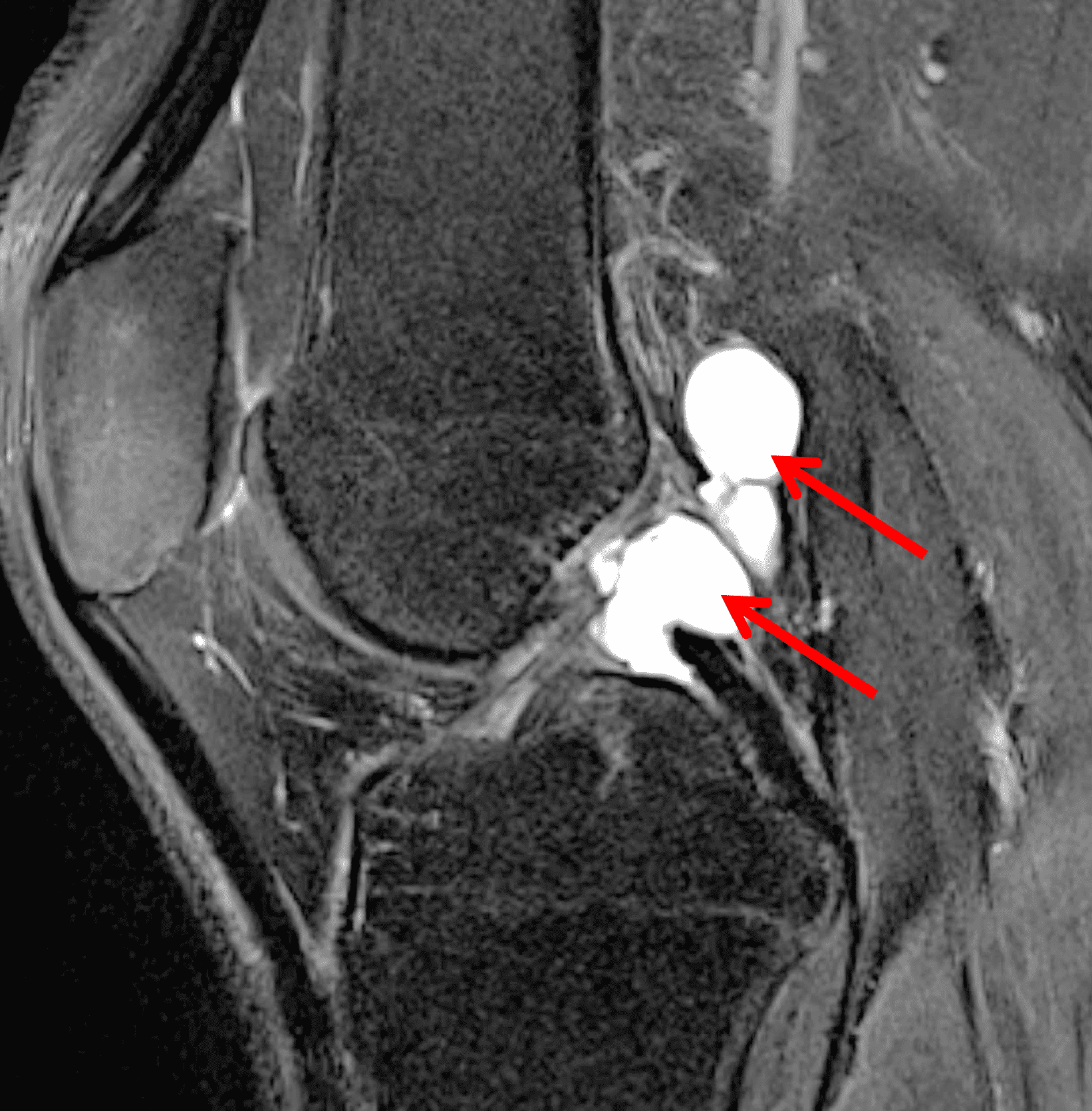 Intra-articular and Peri-articular Masses | Radsource