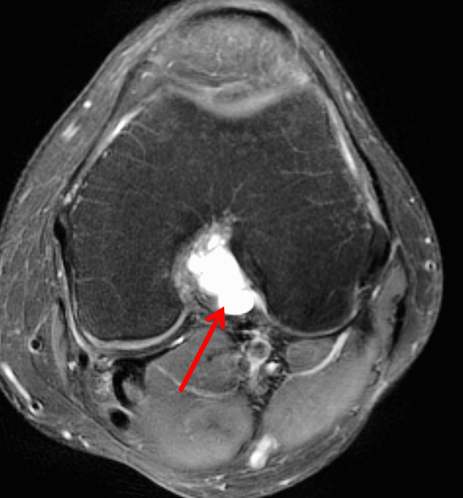 Intra-articular and Peri-articular Masses | Radsource