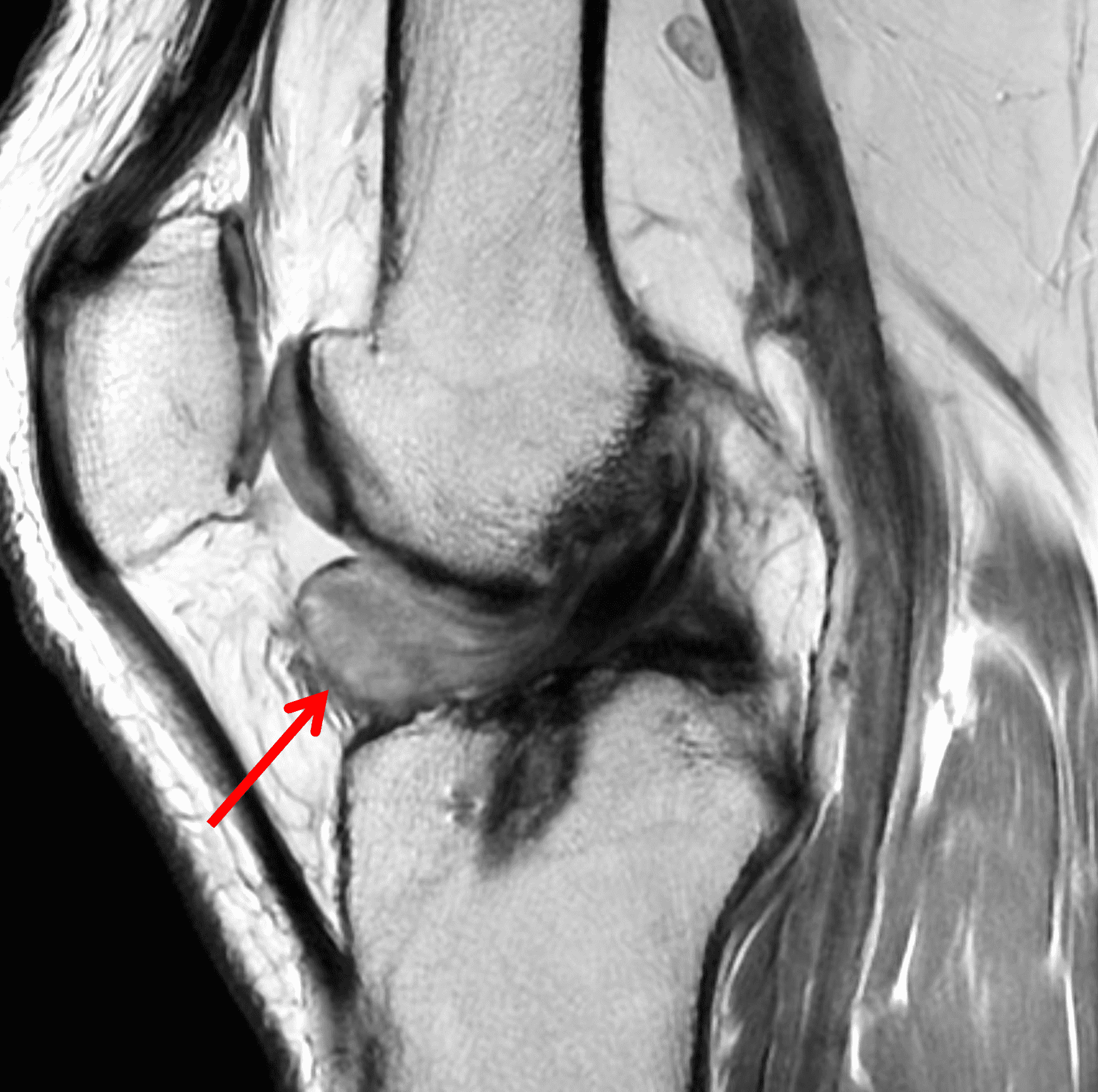 Intra-articular and Peri-articular Masses | Radsource