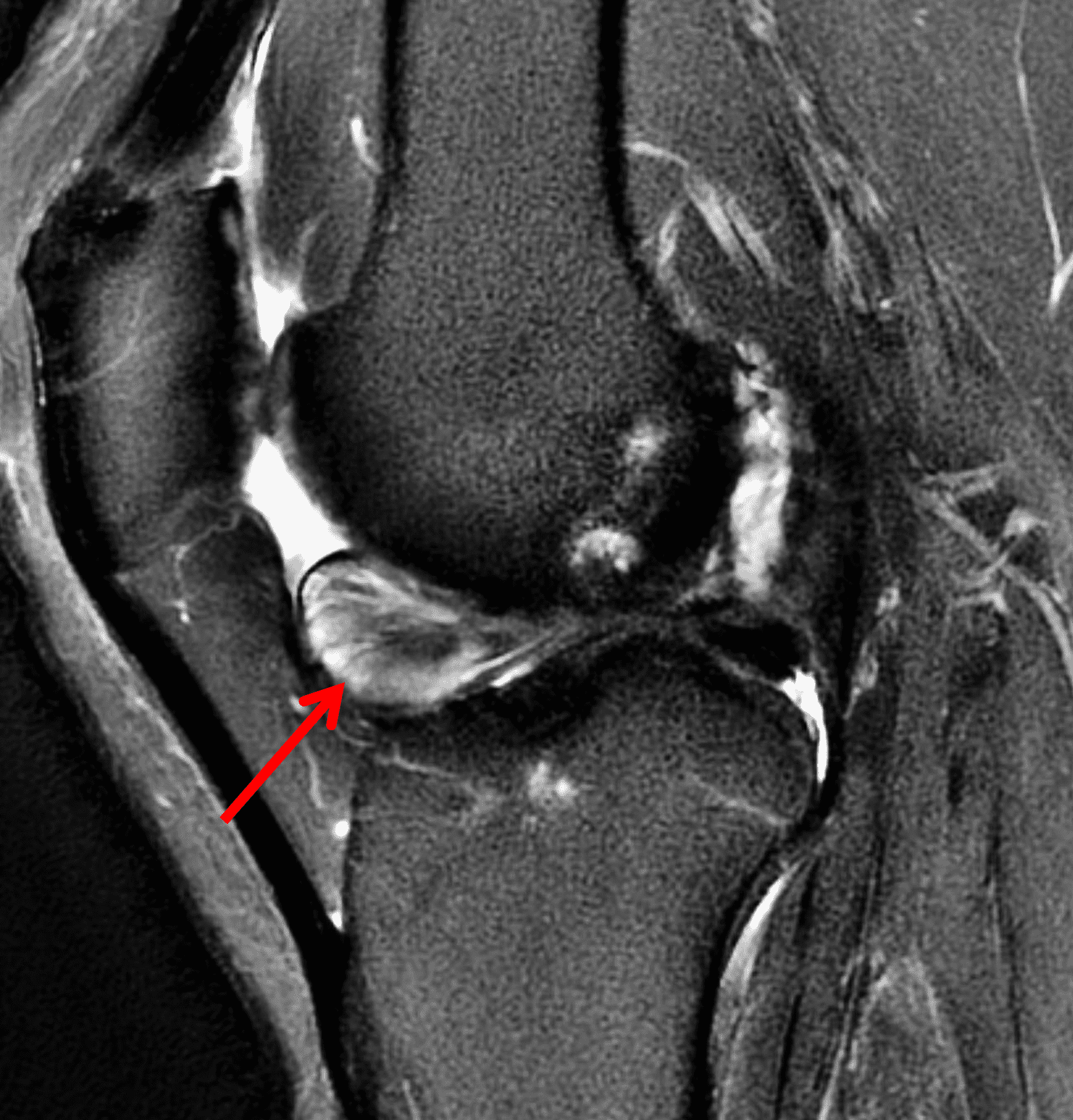 Intra-articular and Peri-articular Masses | Radsource