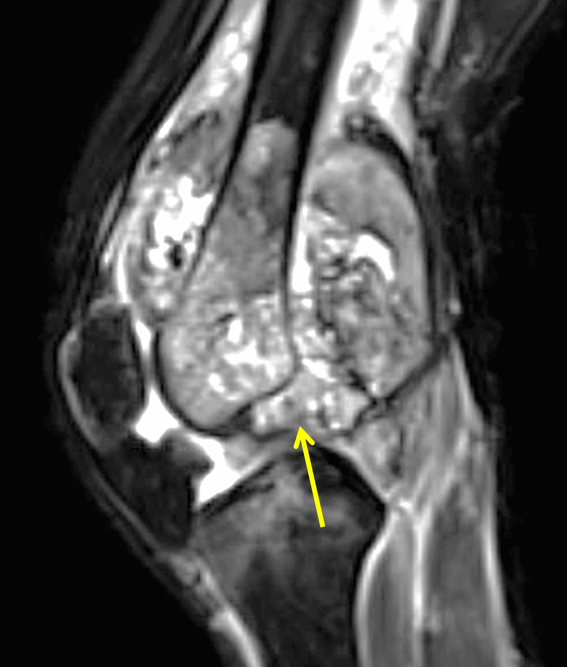 Intra-articular and Peri-articular Masses | Radsource
