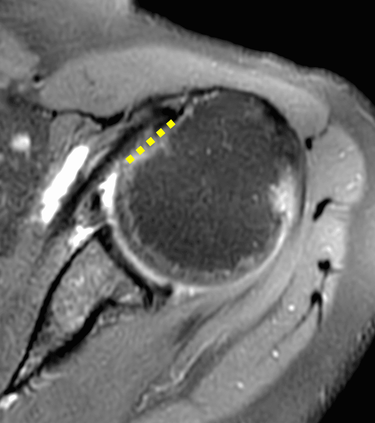 Subscapularis Tendon Tear | Radsource
