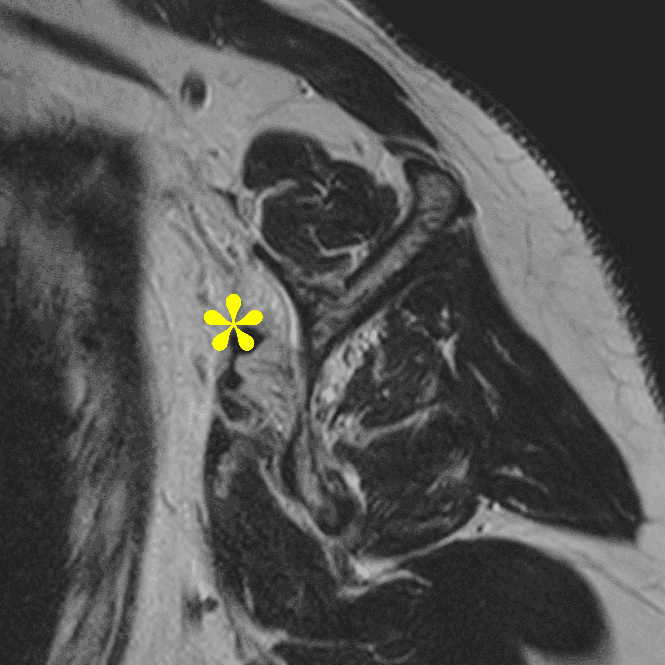 Subscapularis Tendon Tear | Radsource