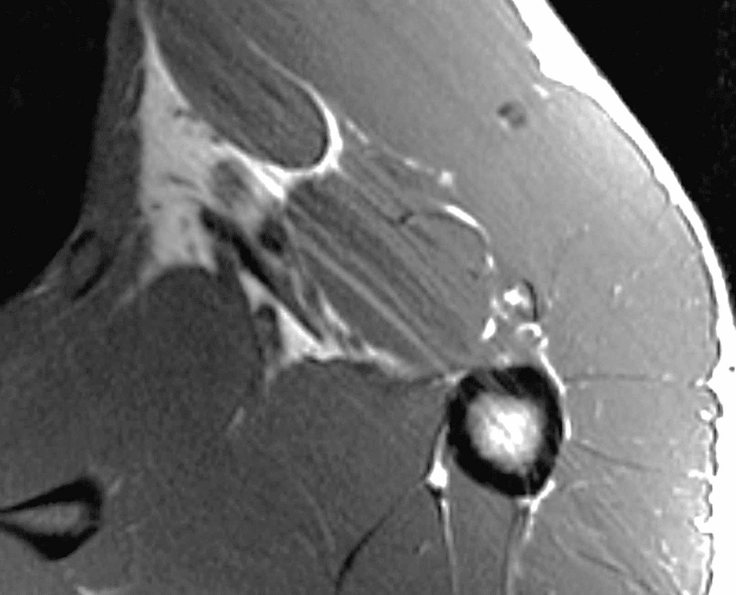 Pectoralis Major Tear | Radsource