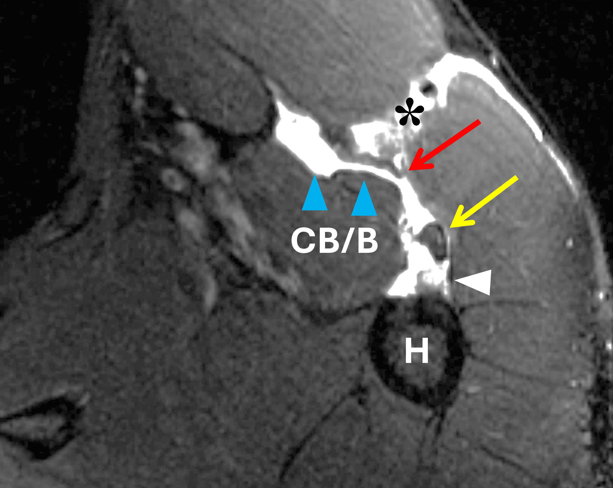 Pectoralis Major Tear | Radsource