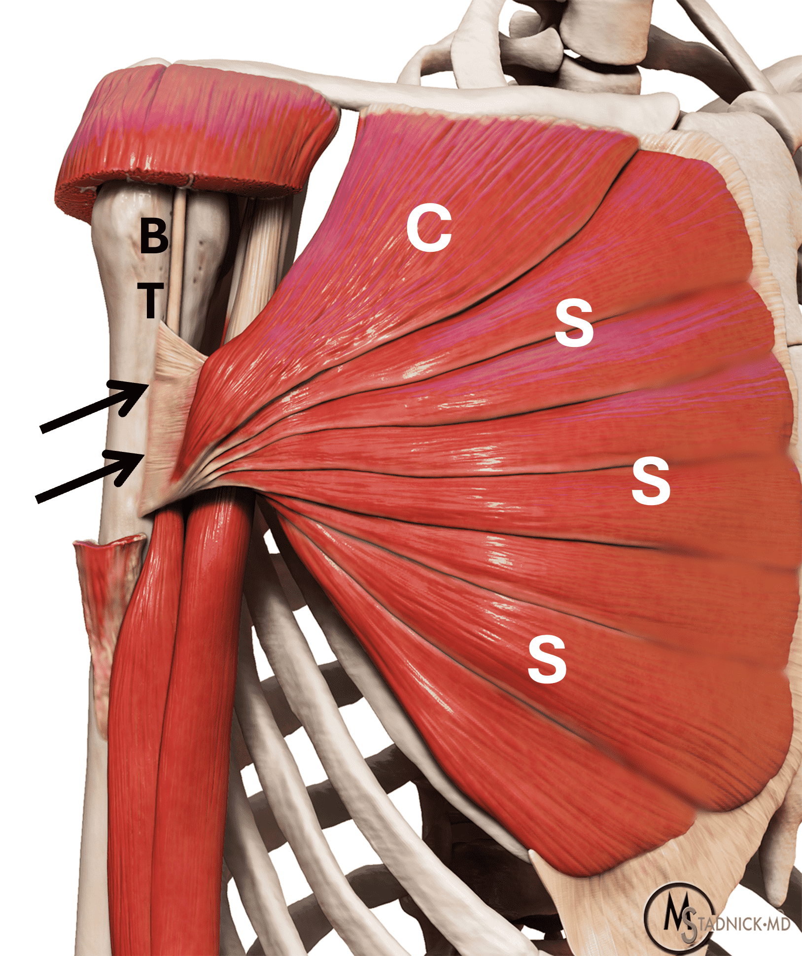 Pectoralis Major Tear | Radsource