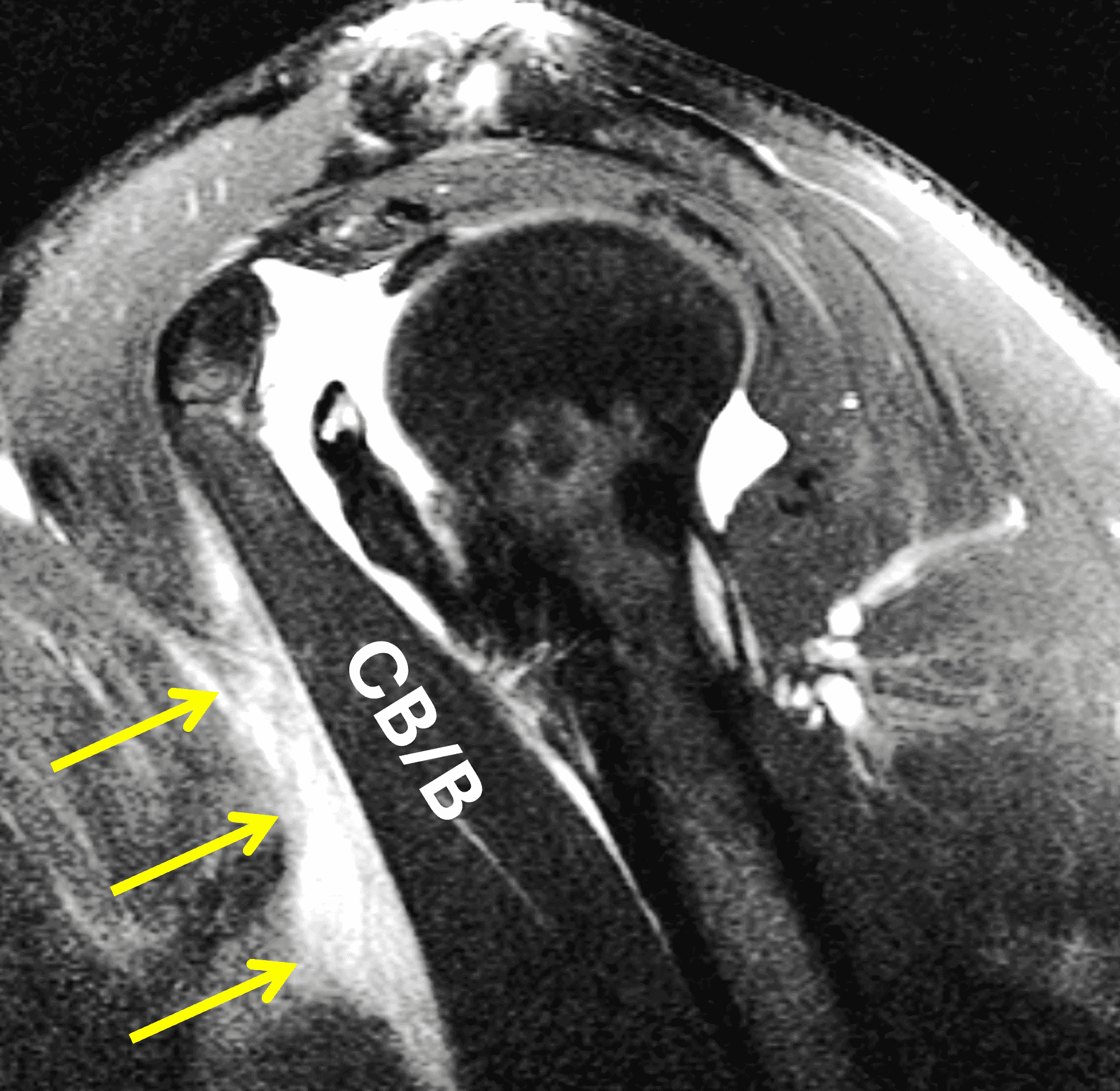 Pectoralis Major Tear | Radsource